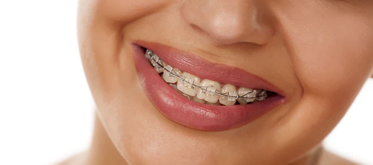 Corsicana Family Orthodontics Install Clear Liner Braces in Corsicana ...